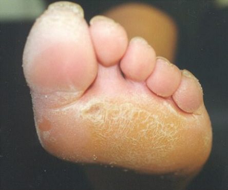 Indicaties Podotherapie