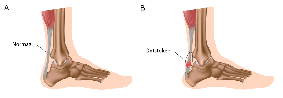 Indicaties Podotherapie